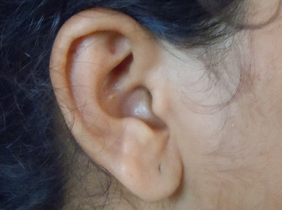 의학용어 a.d., ad, AD = auris dextra 오른쪽 귀