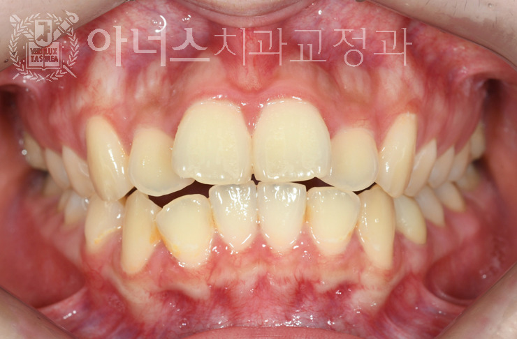 [HONORS Orthodontics] An open-bite case with flared upper teeth treated ...