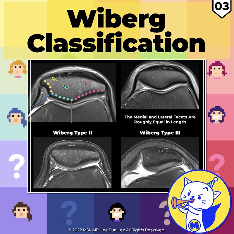 (Fig 4-B.03) Retropatellar Articular Surface and Wiberg Classification