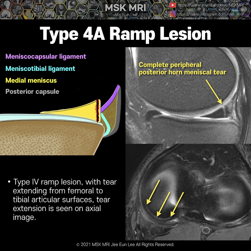 [Tear_25] Ramp lesion_Type 4A: complete peripheral posterior horn ...