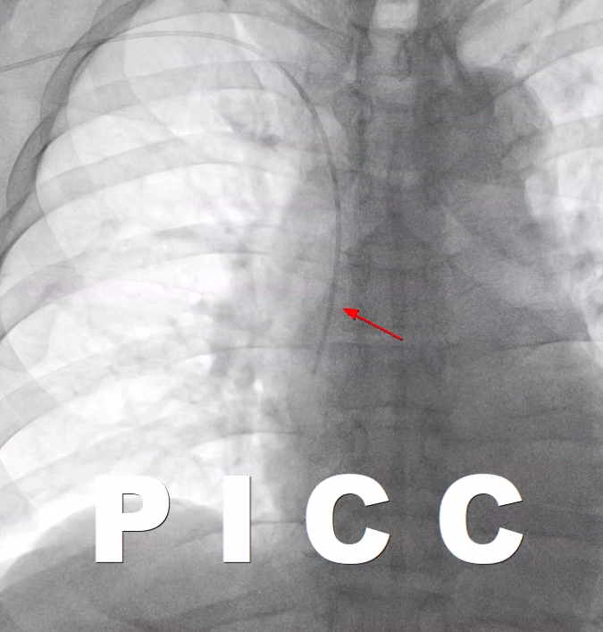 인터벤션 영상의학과 전문의가 알려주는 PICC 시술의 모든 것