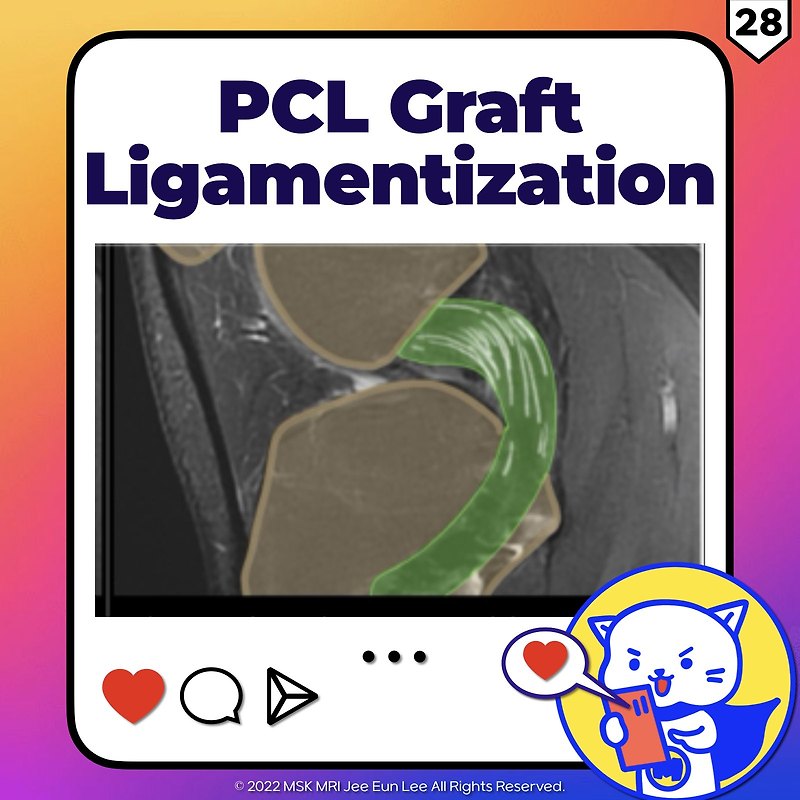 (Fig 2-E.28) PCL Graft Ligamentization