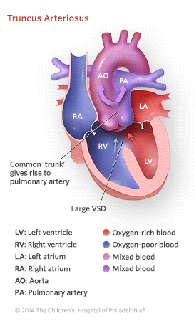 Congenital Heart Diseases (1) - Truncus Arteriosus