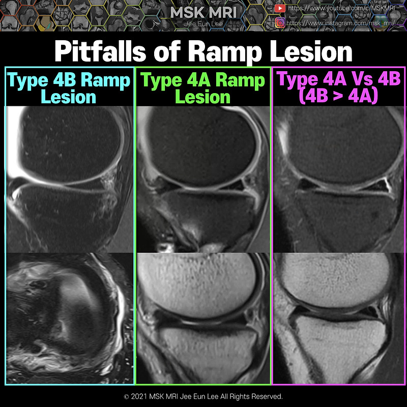 [Tear_29] Ramp lesion_Pitfalls, Type 4A vs 4B lesion, meniscocapsular ...