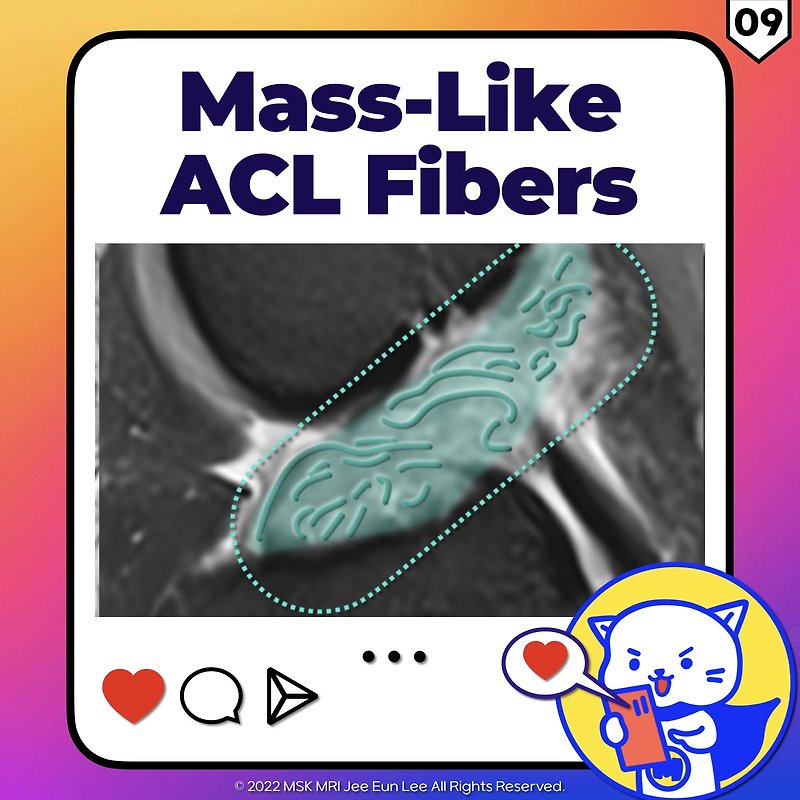 (Fig 2-B.09) Mass-like tissue without normally oriented ACL fibers