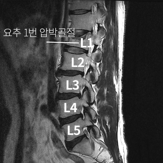 L1 L2 L3 L4 L5 부위의 골절 S320