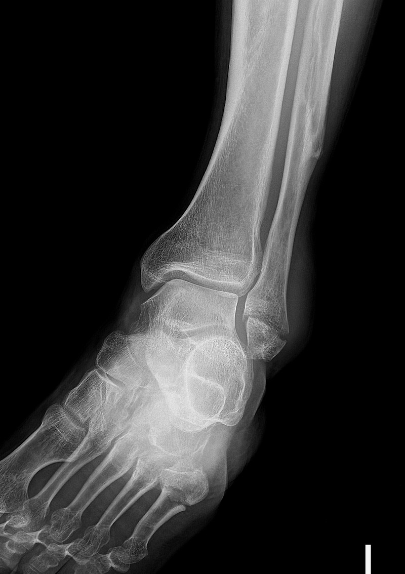 Lateral malleolar(low-transverse) fracture