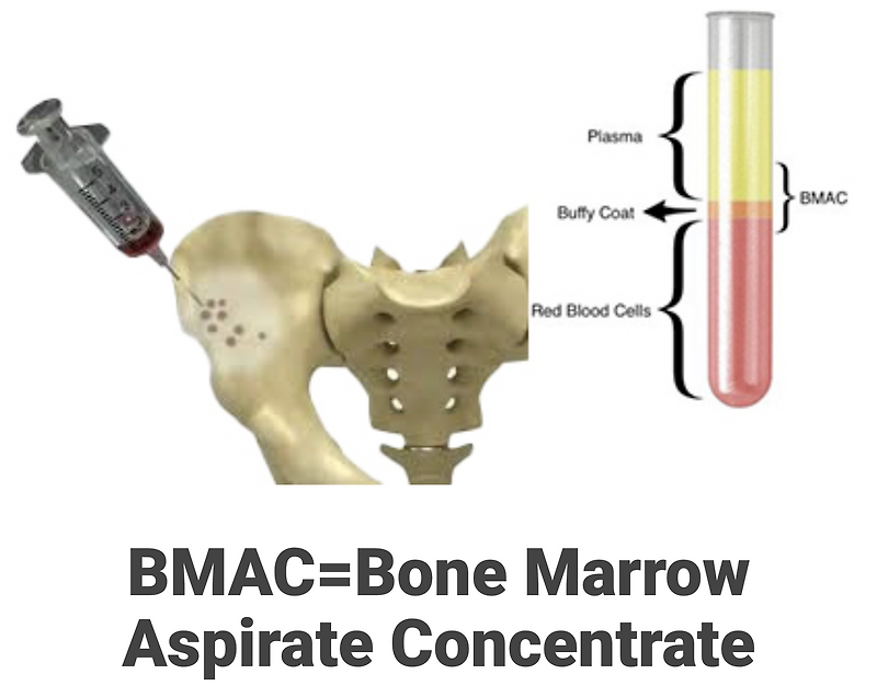 자가골수흡인액주사(BMAC)-무릎 관절염-퇴행성 관절염