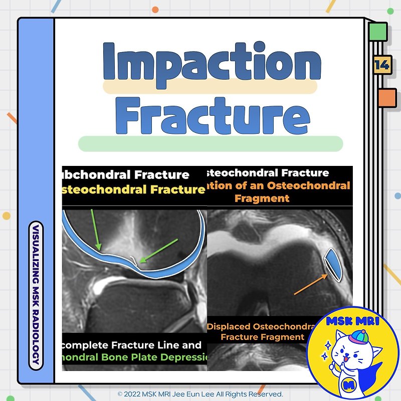 (Fig 5-B.14) Impaction Fracture and Osteochondral Fragment