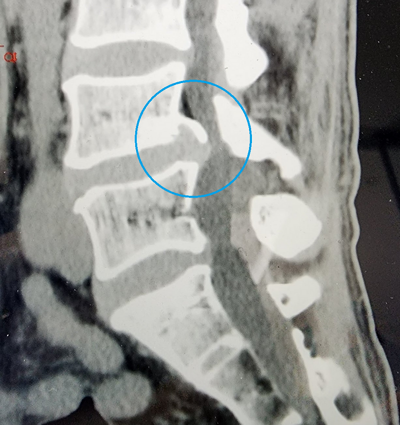 Let's try to solve disc calcification without surgery.