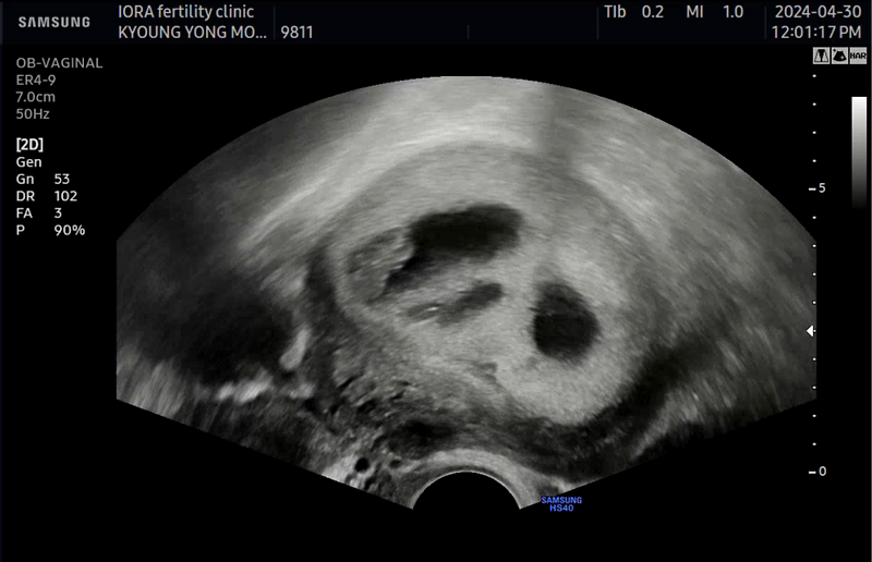 [아빠일기 #2] 8w + 4d / D-220