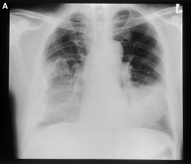 농흉(Pyothorax) : 농흉의 원인, 가슴통증 농흉, 농흉 가래