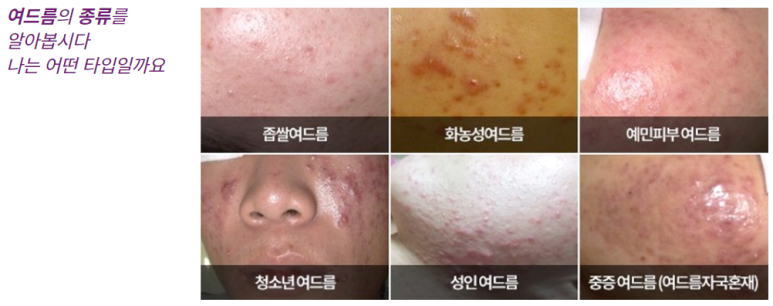 인천여드름치료