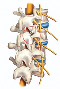 특정 허리 통증 장애: 척추 분리증(Pars Stress Fracture)과 척추 전방전위증(Spondylolisthesis)