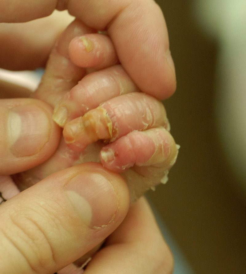 콜로디온 베이비(층판비늘증, 뱀피부): 원인과 증상, 치료법