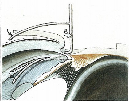 선천성 녹내장 수술, 섬유주절개술, Trabeculotomy. Suture trabeculotomy, 시술과정 방법 처치 관리