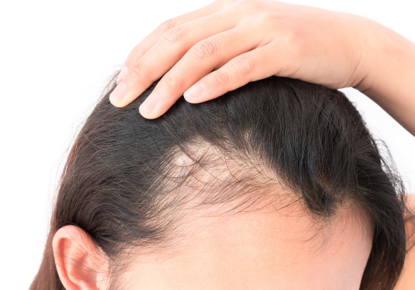 탈모로 인한 고민, 이제 그만! 효과적인 탈모방지 샴푸 추천
