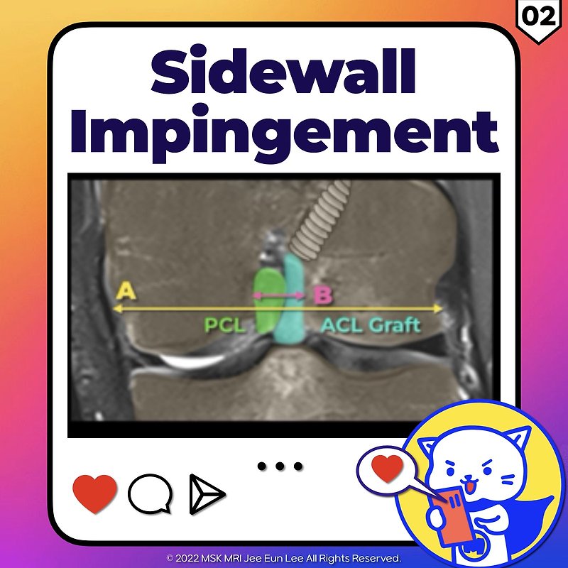 (Fig 2-D.02) Sidewall impingement ACL reconstruction