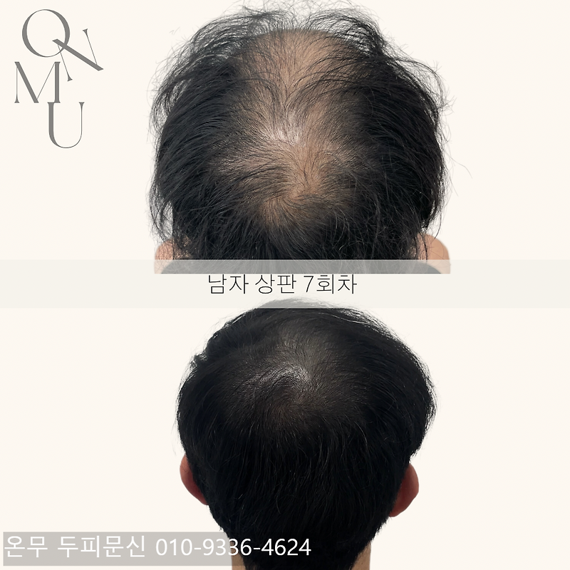 봉담 탈모 두피문신 시술, 자연스러움으로 완성된 정수리 (+가격)