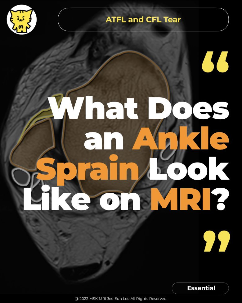 [Essential] What Does an Ankle Sprain Look Like on MRI?