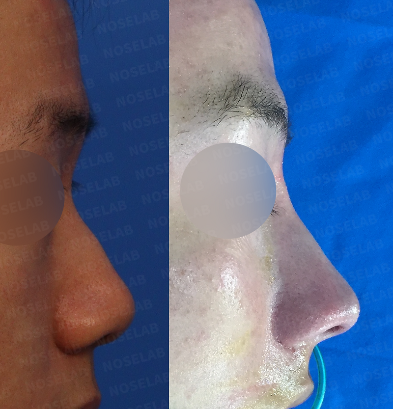 Closed rhinoplasty Korea, bulbous and short nose_noselab