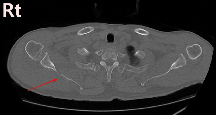 Scapular CT