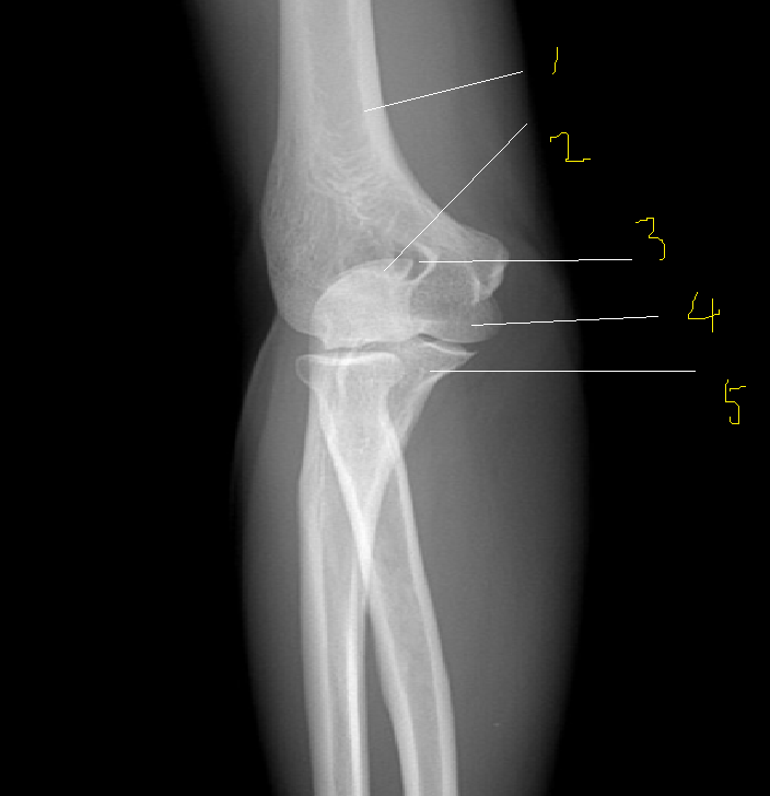 Elbow OBL,Axial