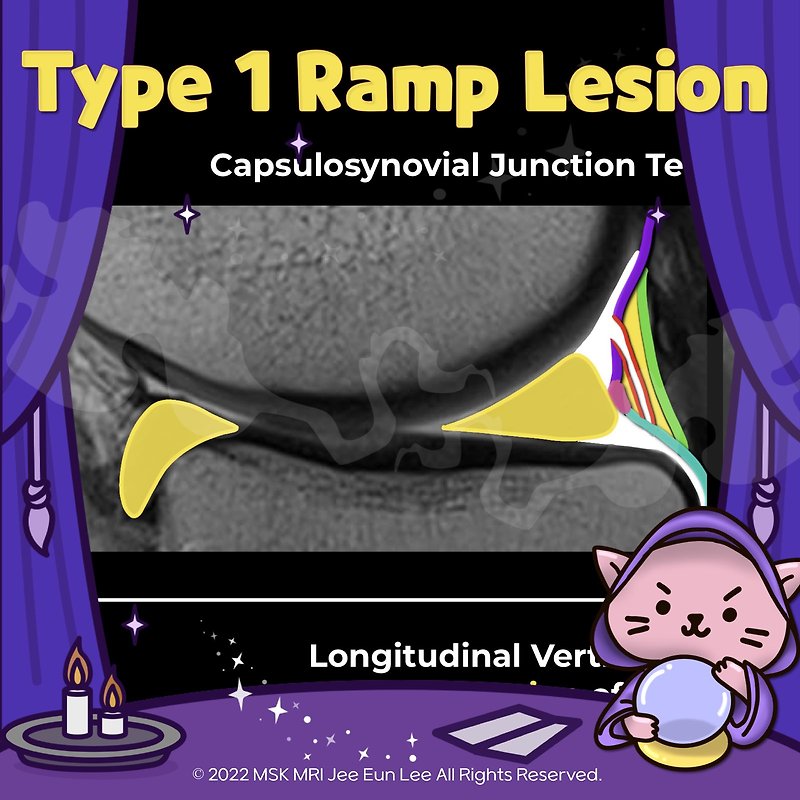 (Fig 1-B.36) Type 1 Ramp lesion, Meniscocapsular lesion