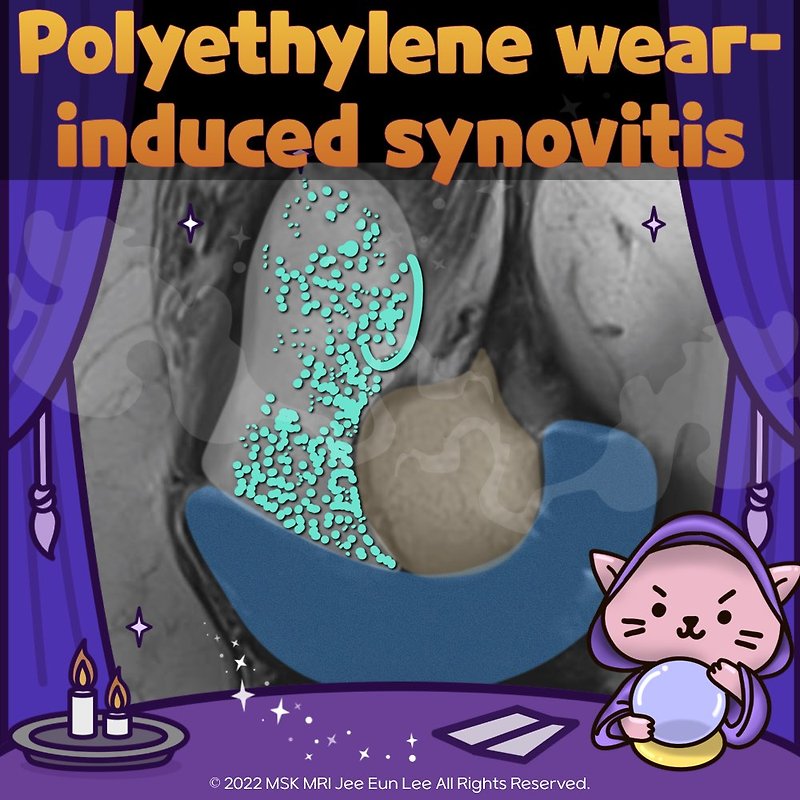 Polyethylene wear–induced synovitis