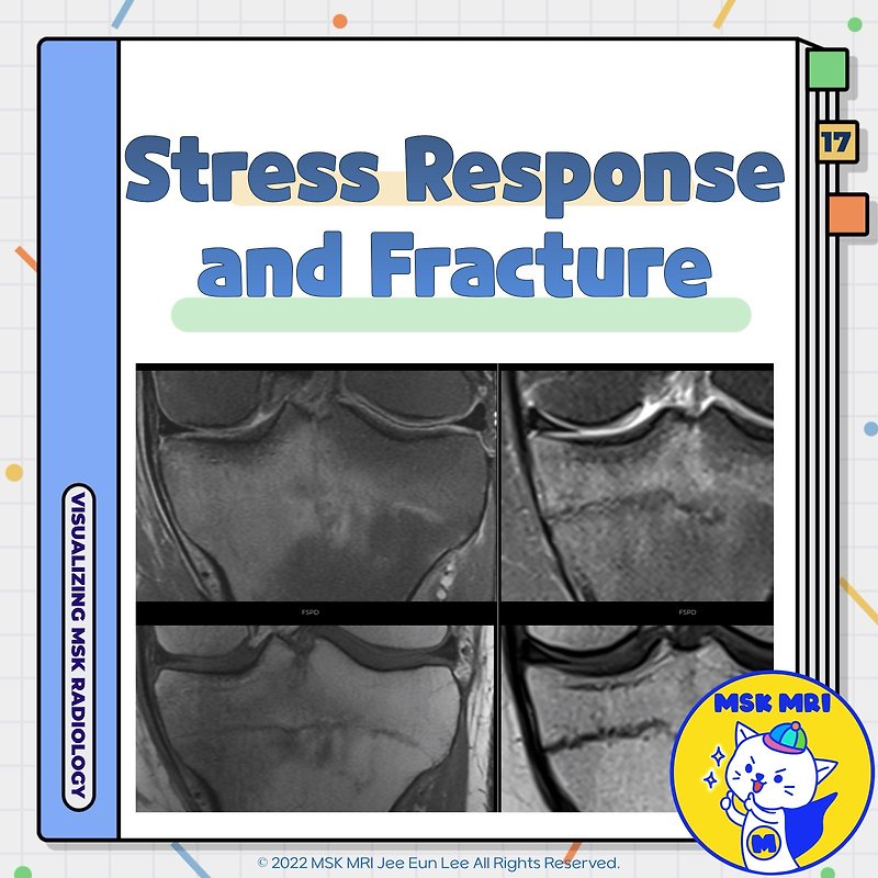 (Fig 5-B.17) Stress Response and Stress Fracture in Cancellous Bone