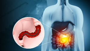 Don't Wait Until 50 for a Colonoscopy: Why You Should Get Tested ...
