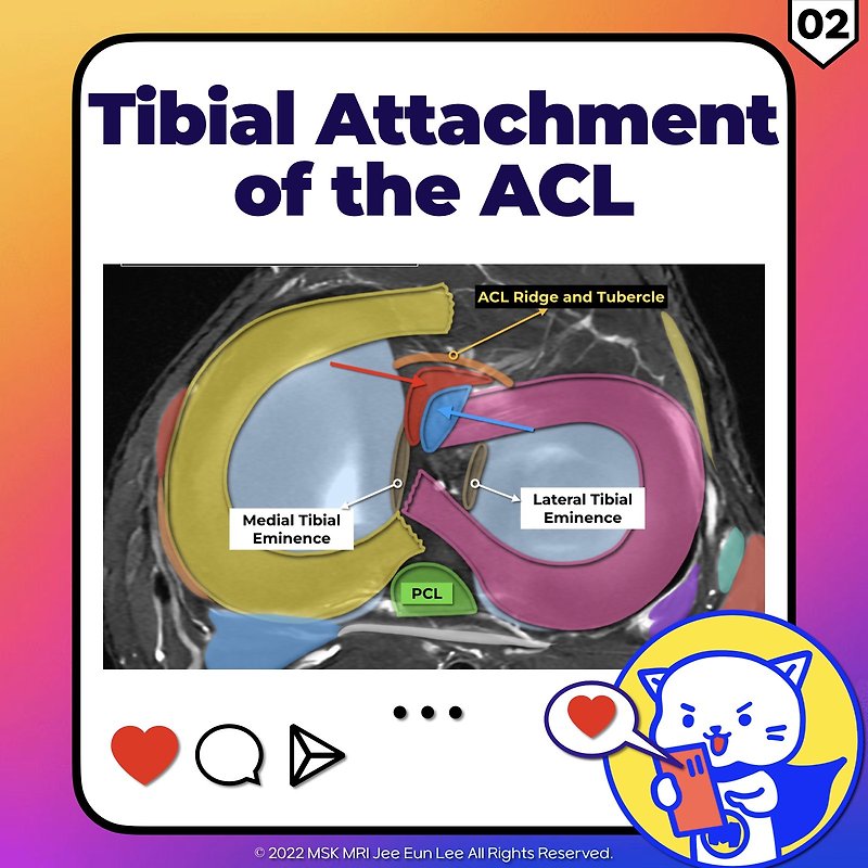(Fig 2-A.02) Tibial attachment of the ACL, ACL footprint