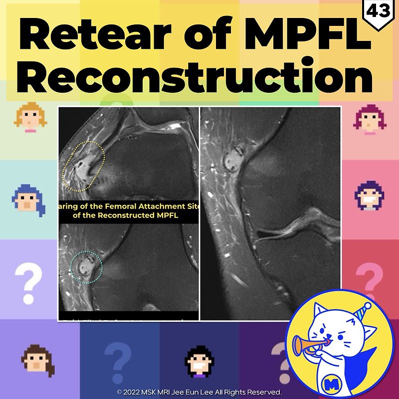 (Fig 4-A.43) Retear of MPFL Reconstruction
