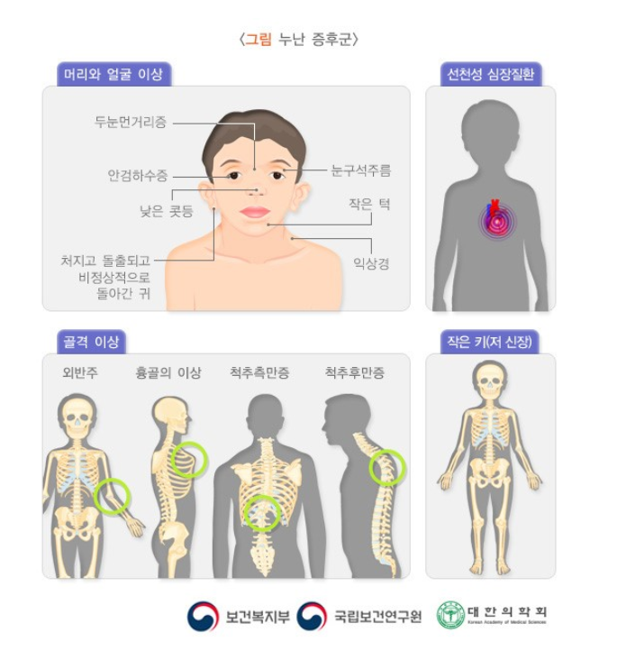 누난 증후군 프래더 윌리 증후군