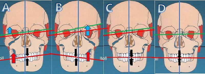 How to treat maxillary canting?