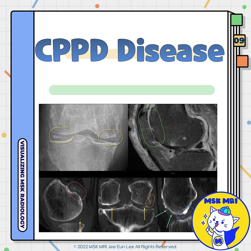 (Fig 5-E.09) Calcium Pyrophosphate Dihydrate Deposition Disease