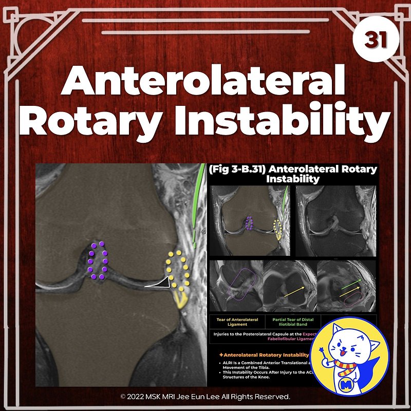 (Fig 3-B.31) Anterolateral rotary instability