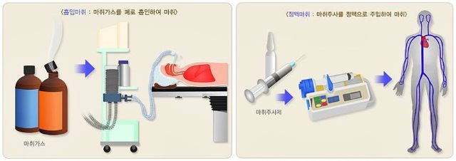 TIVA 마취 (전정맥마취)