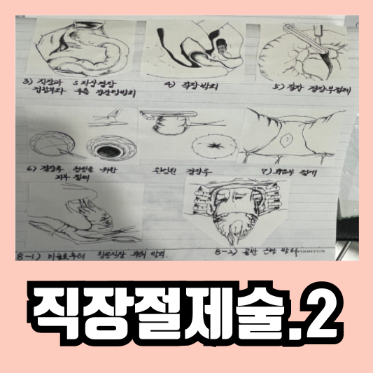 abdominoperioneal excision of the rectum, mile's op 2편