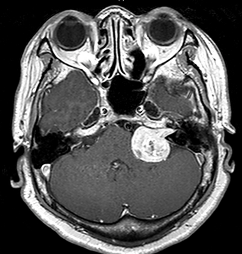 Cerebellopontine angle tumor - 소뇌교각종양 (CPA tumor)