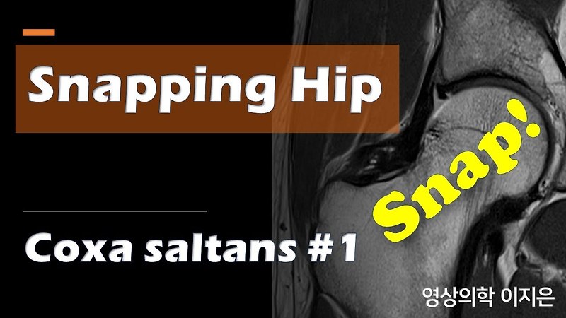 [HYPERLINK] Coxa saltans, Snapping Hip, Iliotibial band, 발음성 고관절, 스냅핑 ...