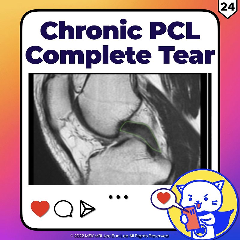 (Fig 2-E.24) Chronic Complete Tear of the PCL - Part 2