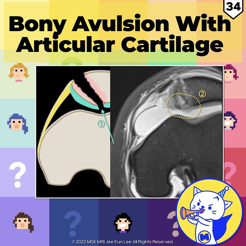 (Fig 4-A.34) Type P2/ Bony Avulsion with Articular Cartilage from ...