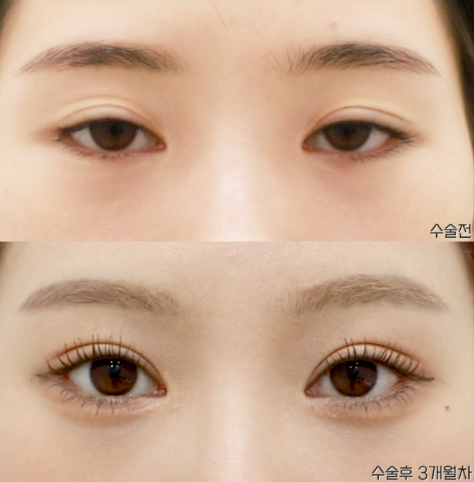 Forehead Lift and Non-Incisional Ptosis Correction (Revision) (Pre-Op ...