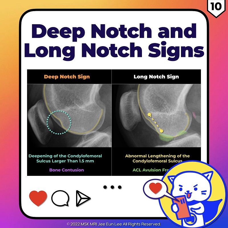 Fig 2 B10 Deep Notch And Long Notch Signs