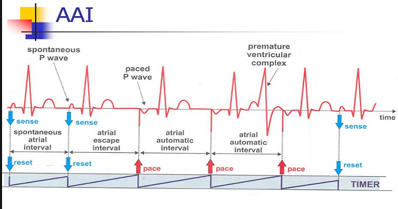 Temporary pacemaker (임시 인공 심박동기) Mode 및 Rhythm ① AAI mode