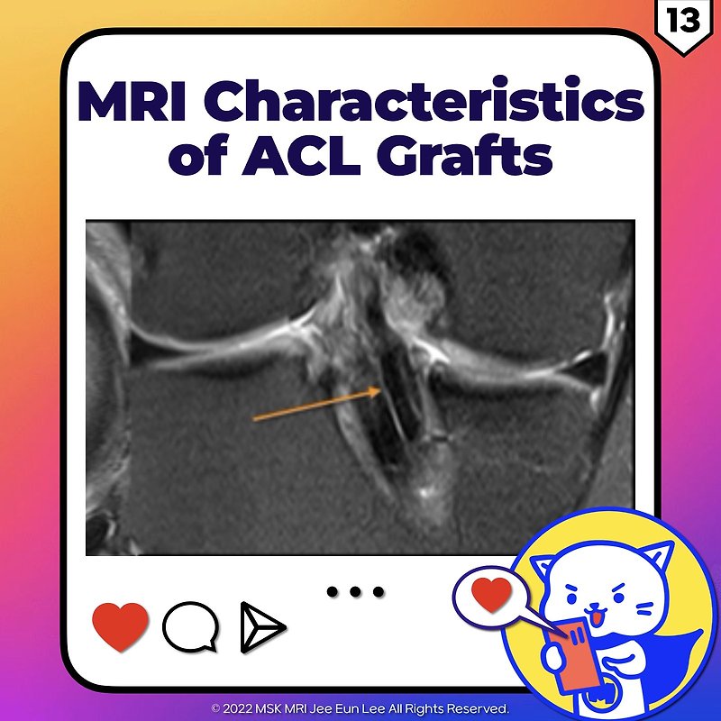 (Fig 2-C.13) MRI Characteristics of Different Graft Type