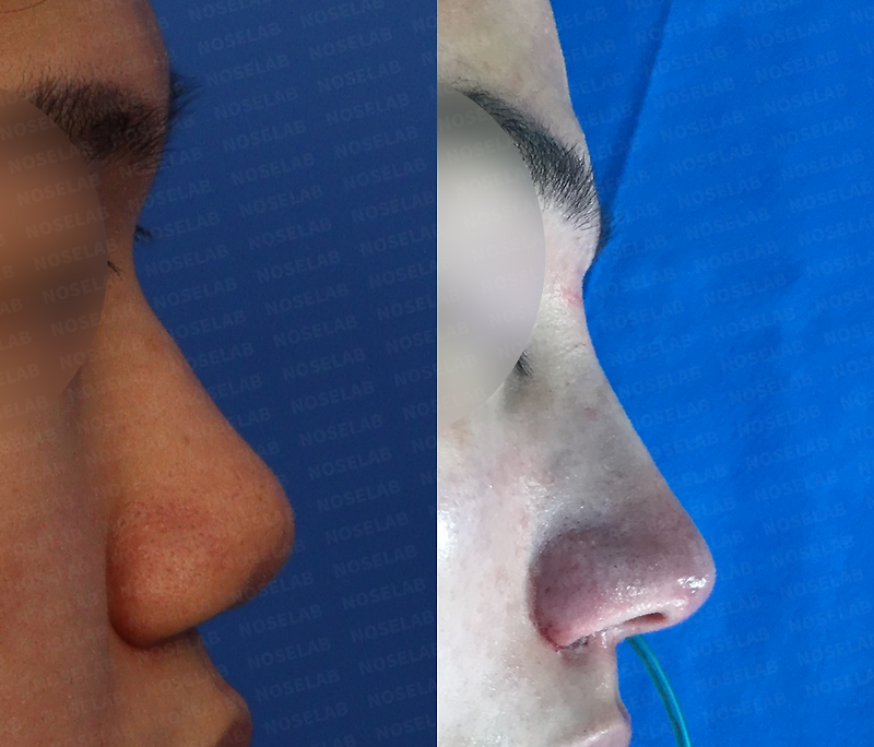 Closed rhinoplasty Korea +bulbous and wide nose +big alar correction(self rib)