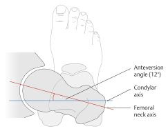 크레이그 검사(Craig's test)[대퇴 전경 테스트]