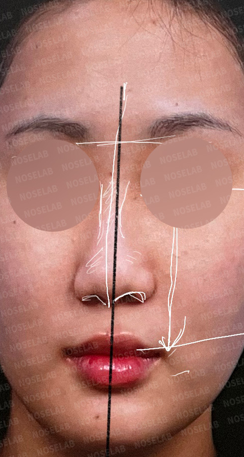 Closed Rhinoplasty Korea + deviated nose